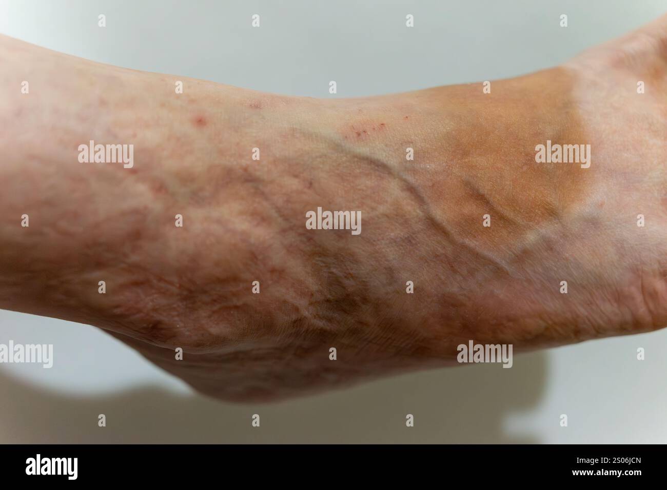 A close-up view of an aging foot, showing the skin's texture and ...
