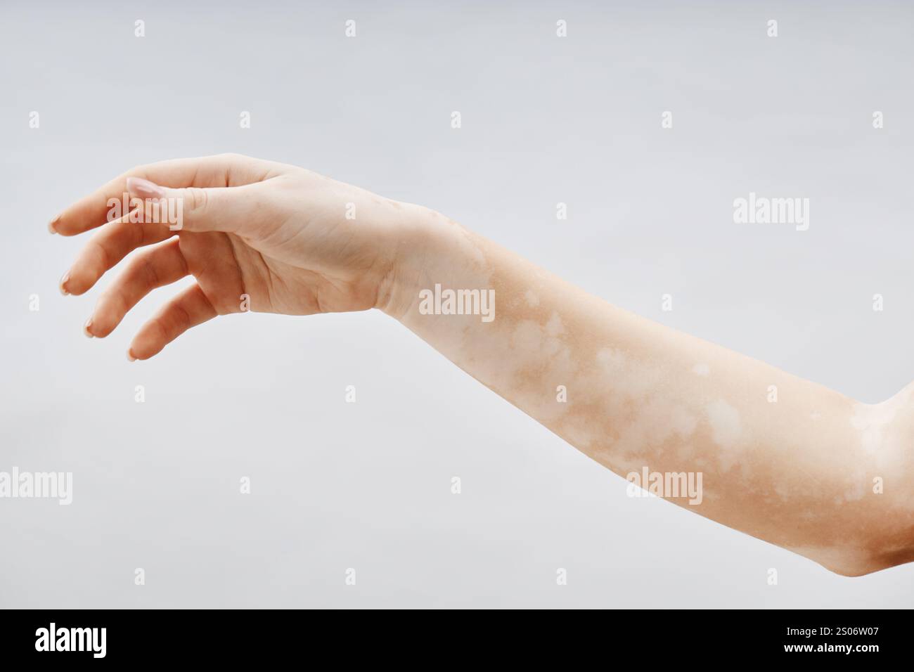 Close up on female arm in elegant gesture showcasing skin with vitiligo ...