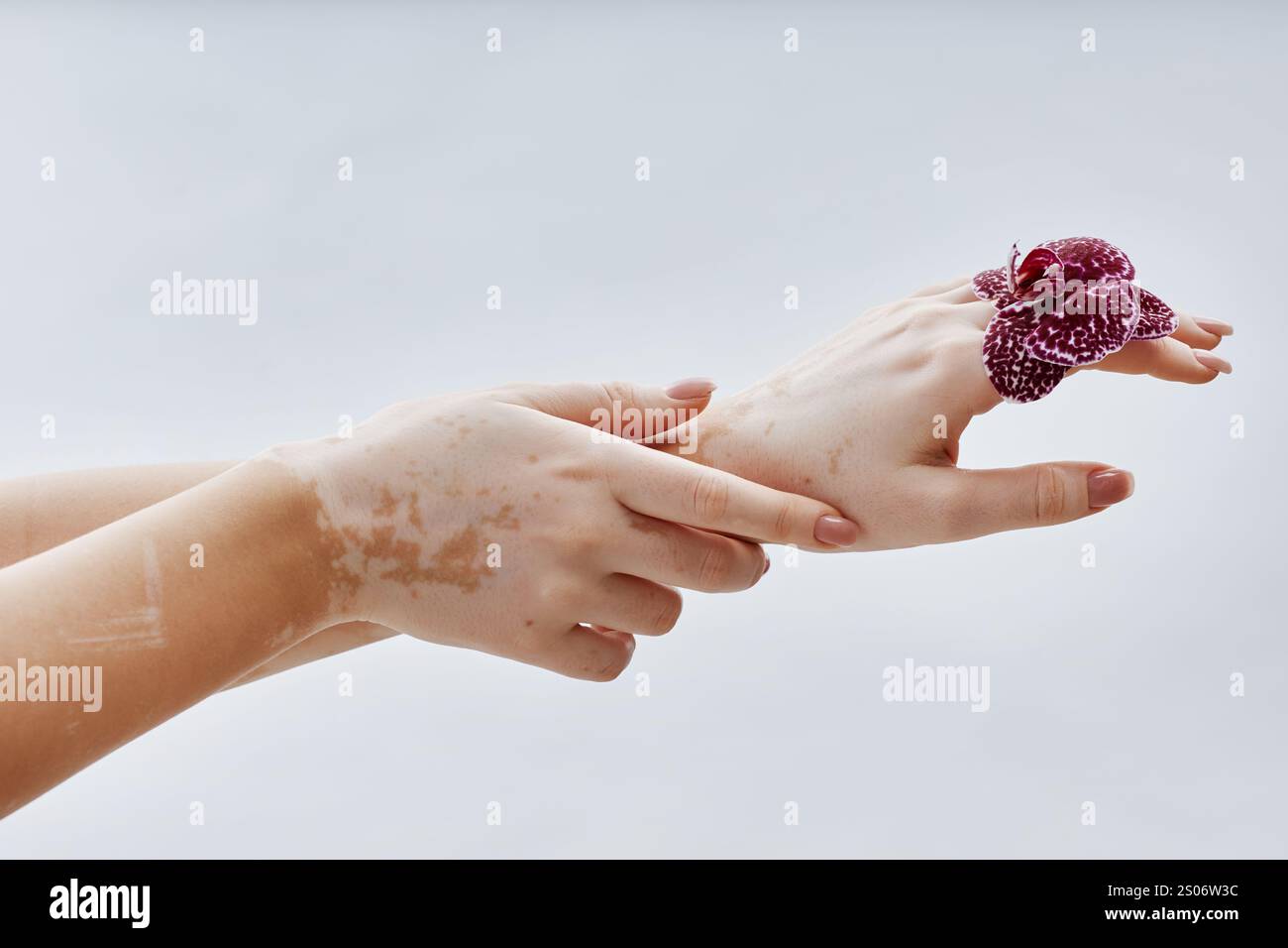 Close up on female hands with pale vitiligo patches and spotted purple ...