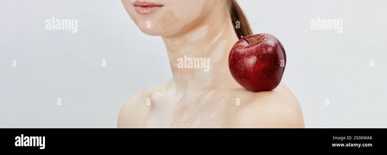 Website header shot red apple on shoulder of young woman with vitiligo ...