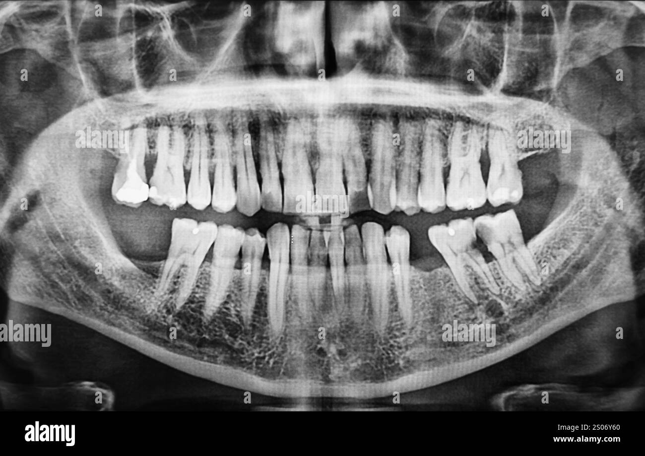 Molar caries x-ray dentist clinic diagnosis. Health care radiography ...