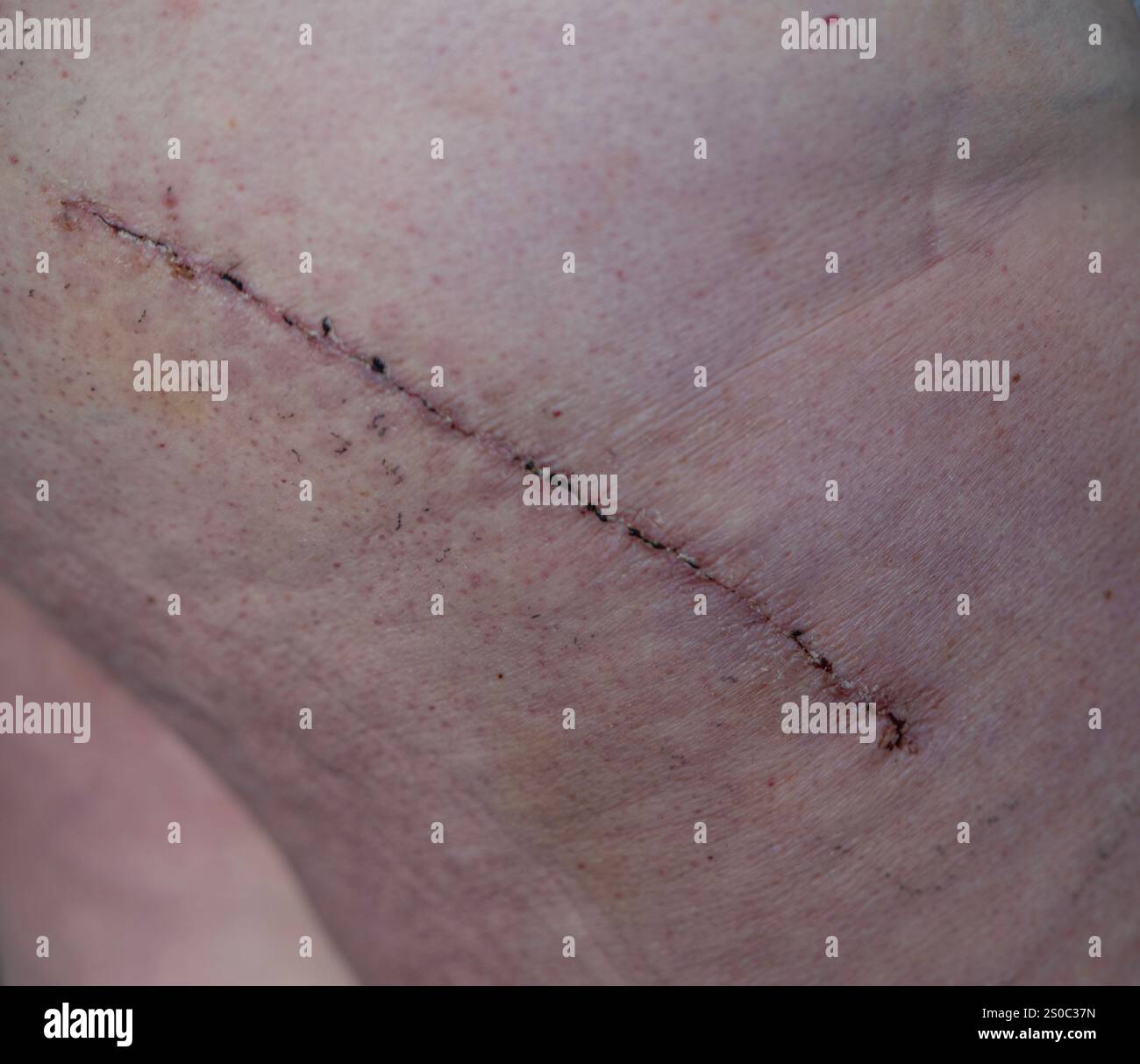 Hip surgery scar after 3 weeks Stock Photo - Alamy
