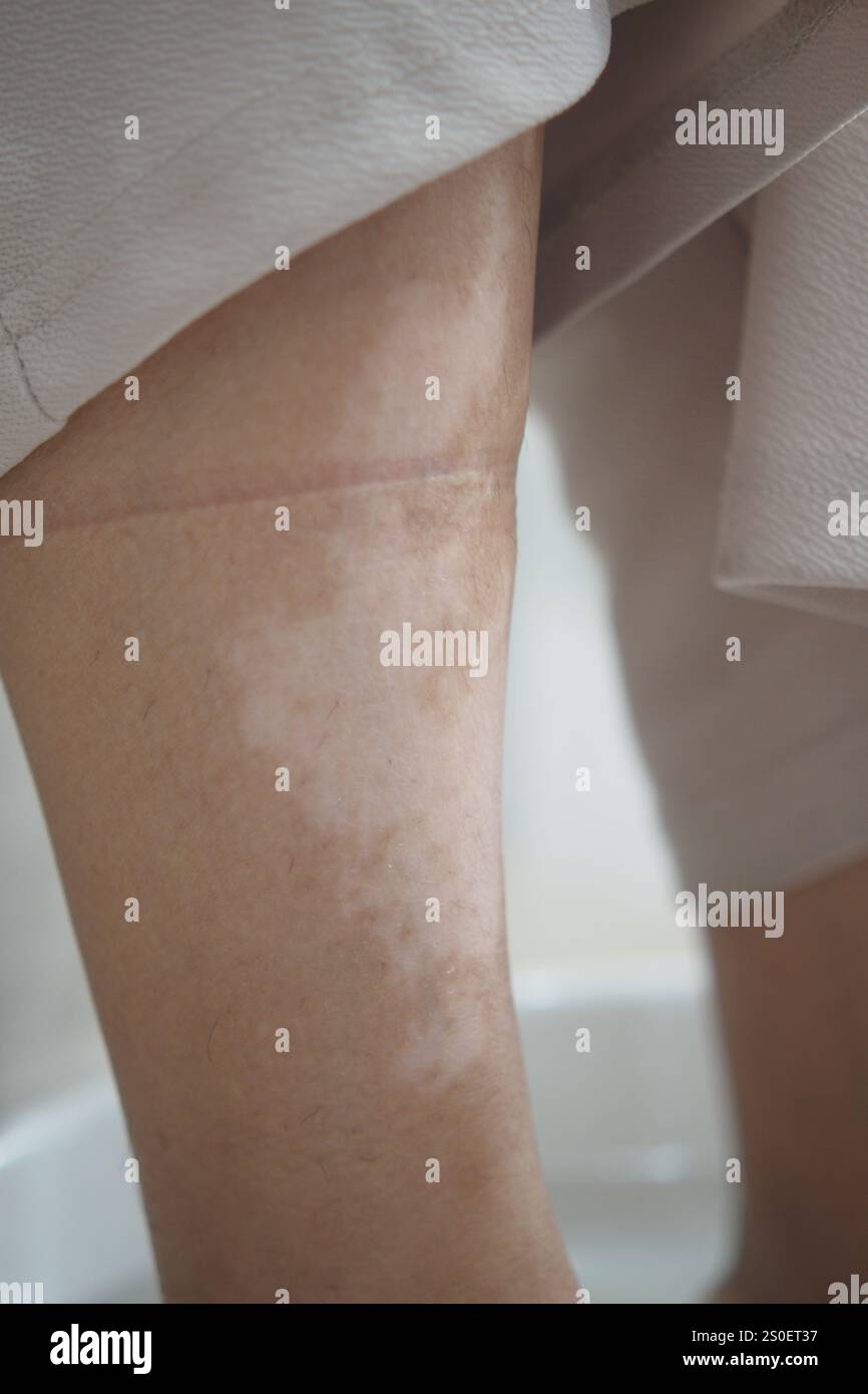feet with vitiligo skin condition Stock Photo - Alamy