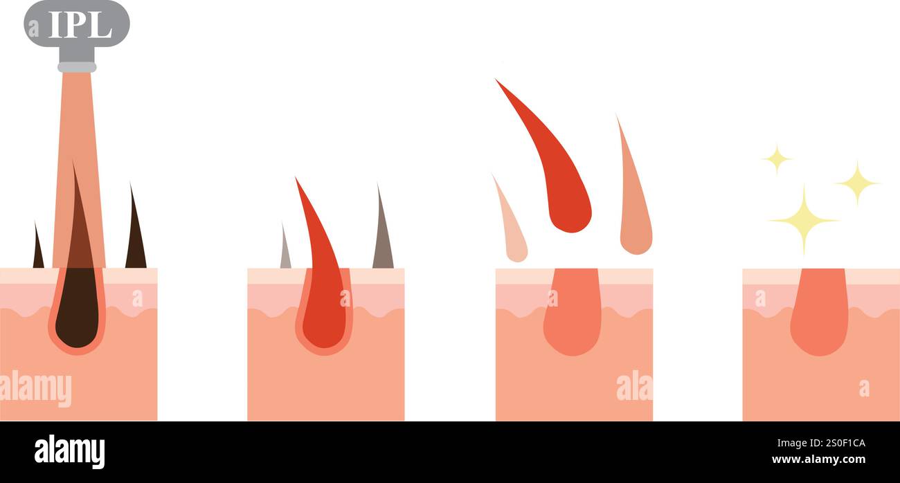 Laser hair removal steps. Process of laser epilation infographic. Human ...