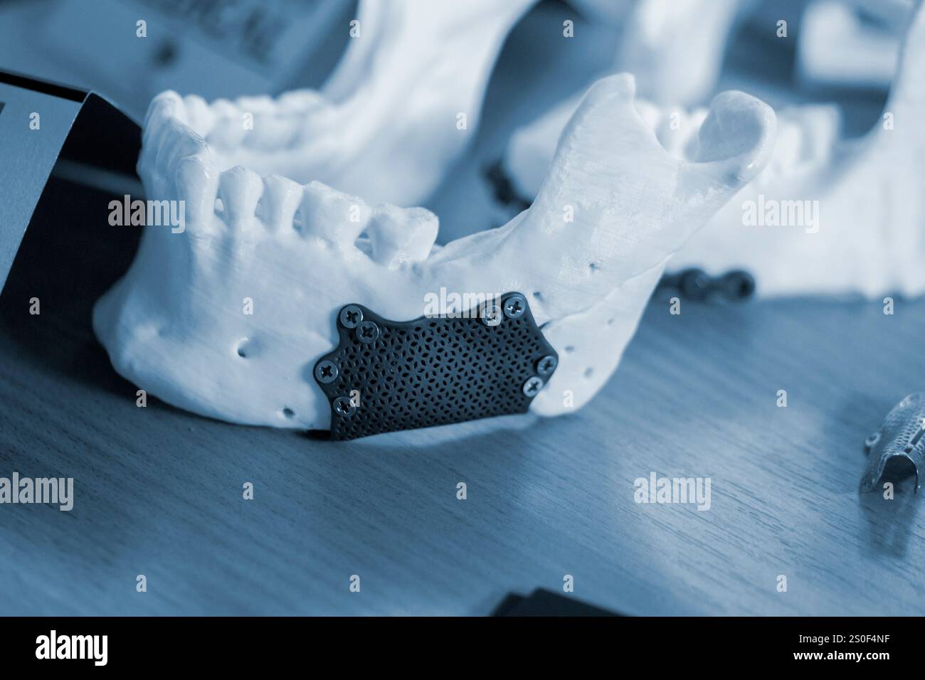 Prototype of lower human jaw with medical titanium implant from ...