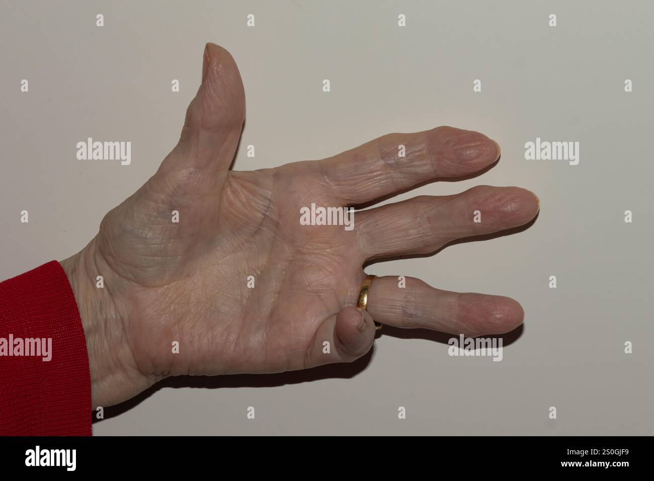 Highly detailed close-up of a senior woman's hand with four fingers ...