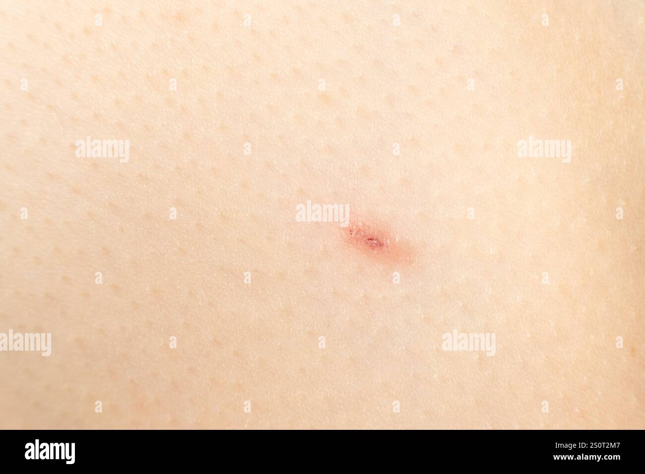 Macro skin with chickenpox, vesicles at different stages Stock Photo ...