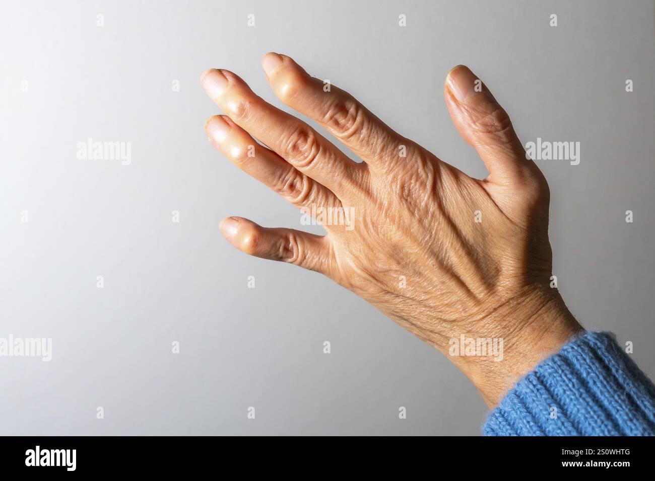 Close up of a senior woman's hand, revealing swollen joints and ...
