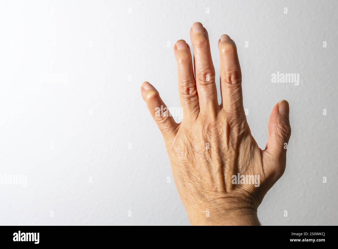 Close up of a female hand with visible signs of arthritis, highlighting ...