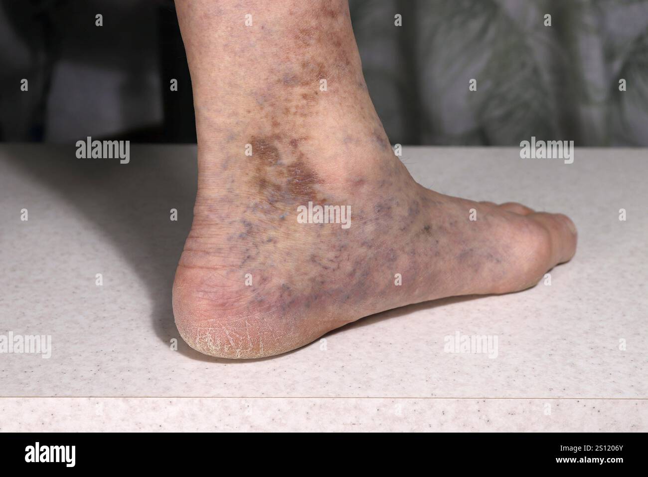 Human leg with severe reddening of the skin Stock Photo - Alamy