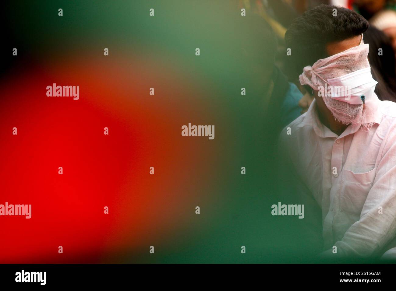 Dhaka, Dhaka, Bangladesh. 31st Dec, 2024. Khokon Chandra Barman who lost his nose and part of ...