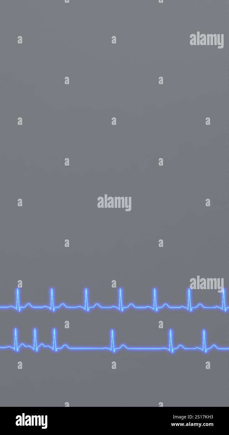 ECG graphs comparison of normal heart rhythm and arrhythmia Stock Photo ...