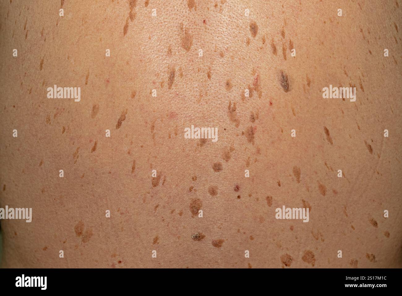 Brown spots and freckles on the back of an old man. Skin problems Stock ...