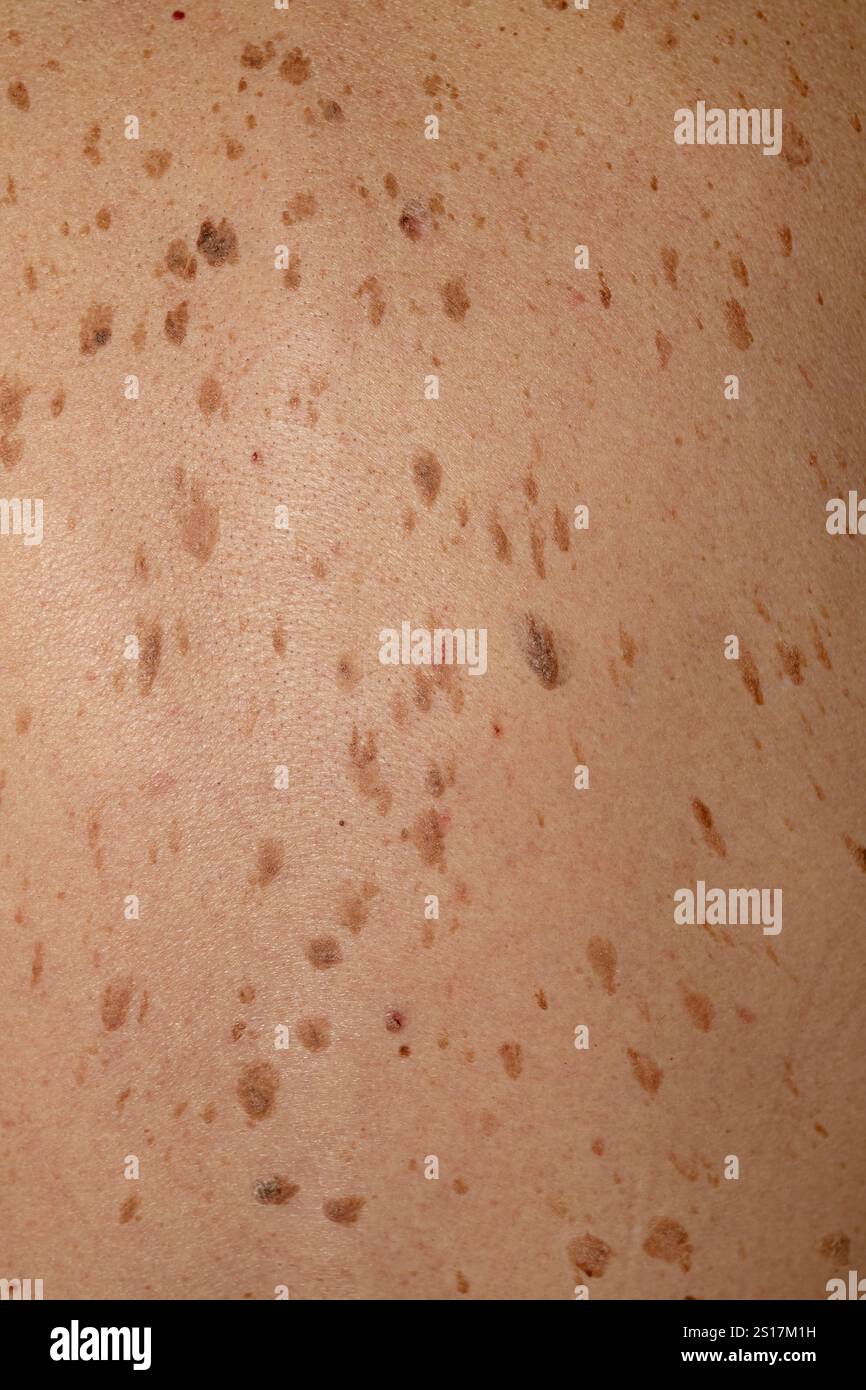 Brown spots and freckles on the back of an old man. Skin problems Stock ...