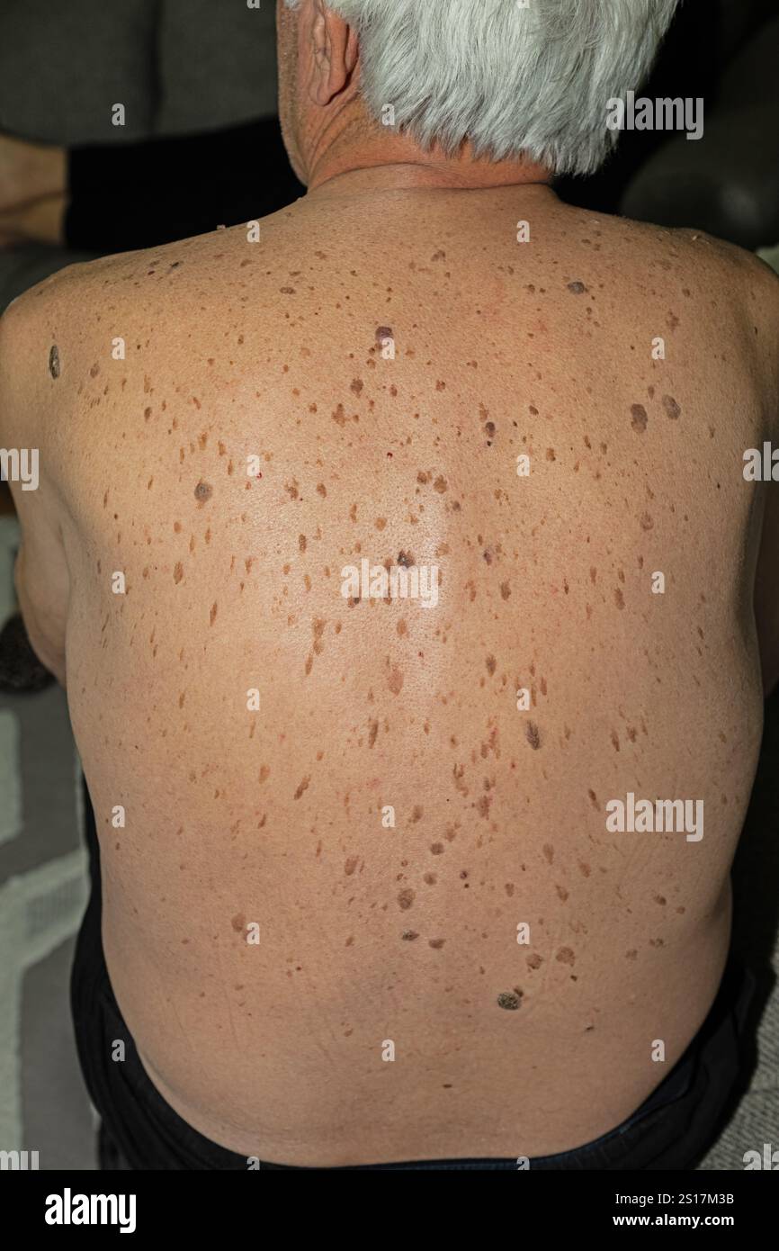Brown spots and freckles on the back of an old man. Skin problems Stock ...