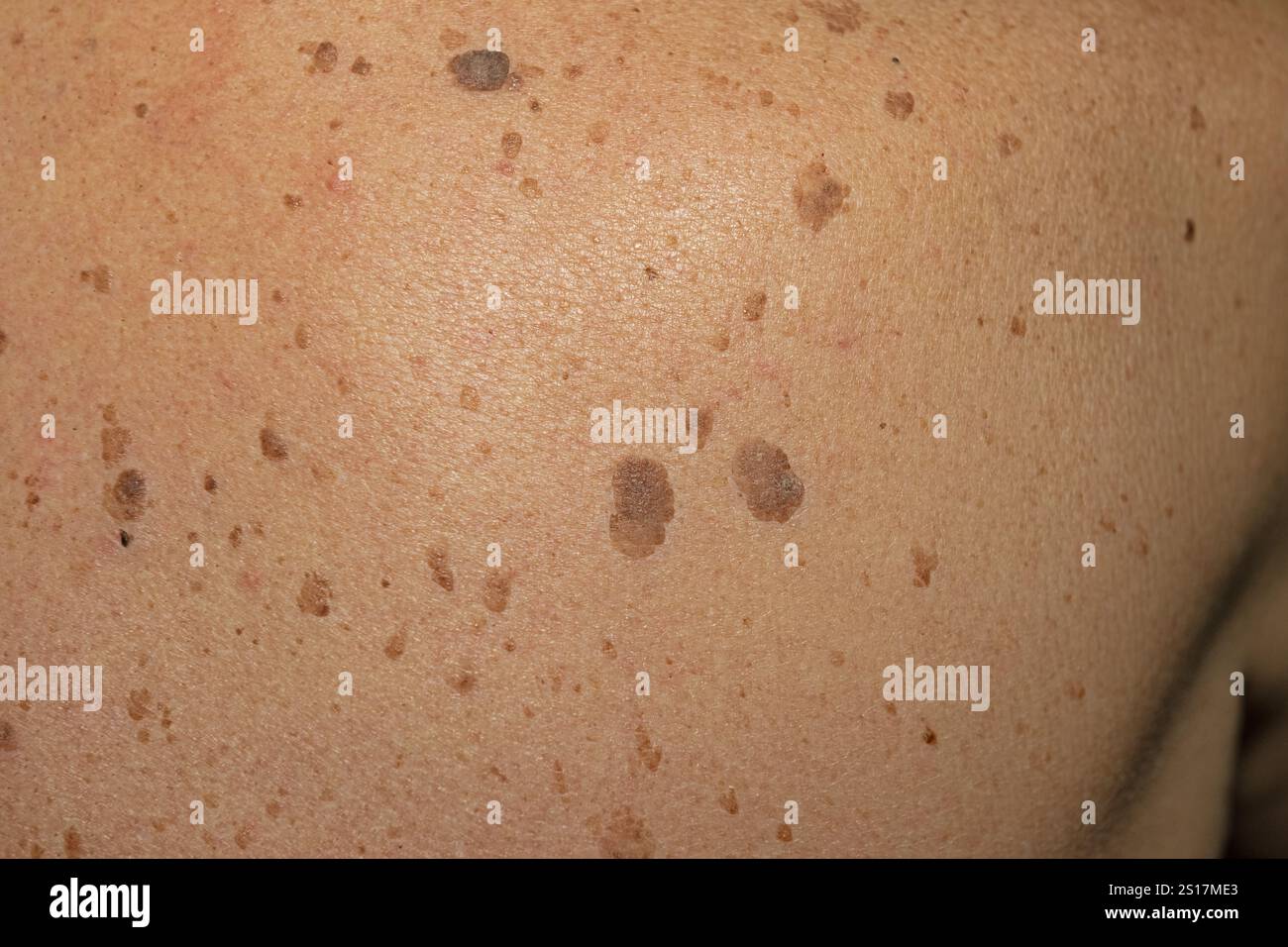 Brown spots and freckles on the back of an old man. Skin problems Stock ...