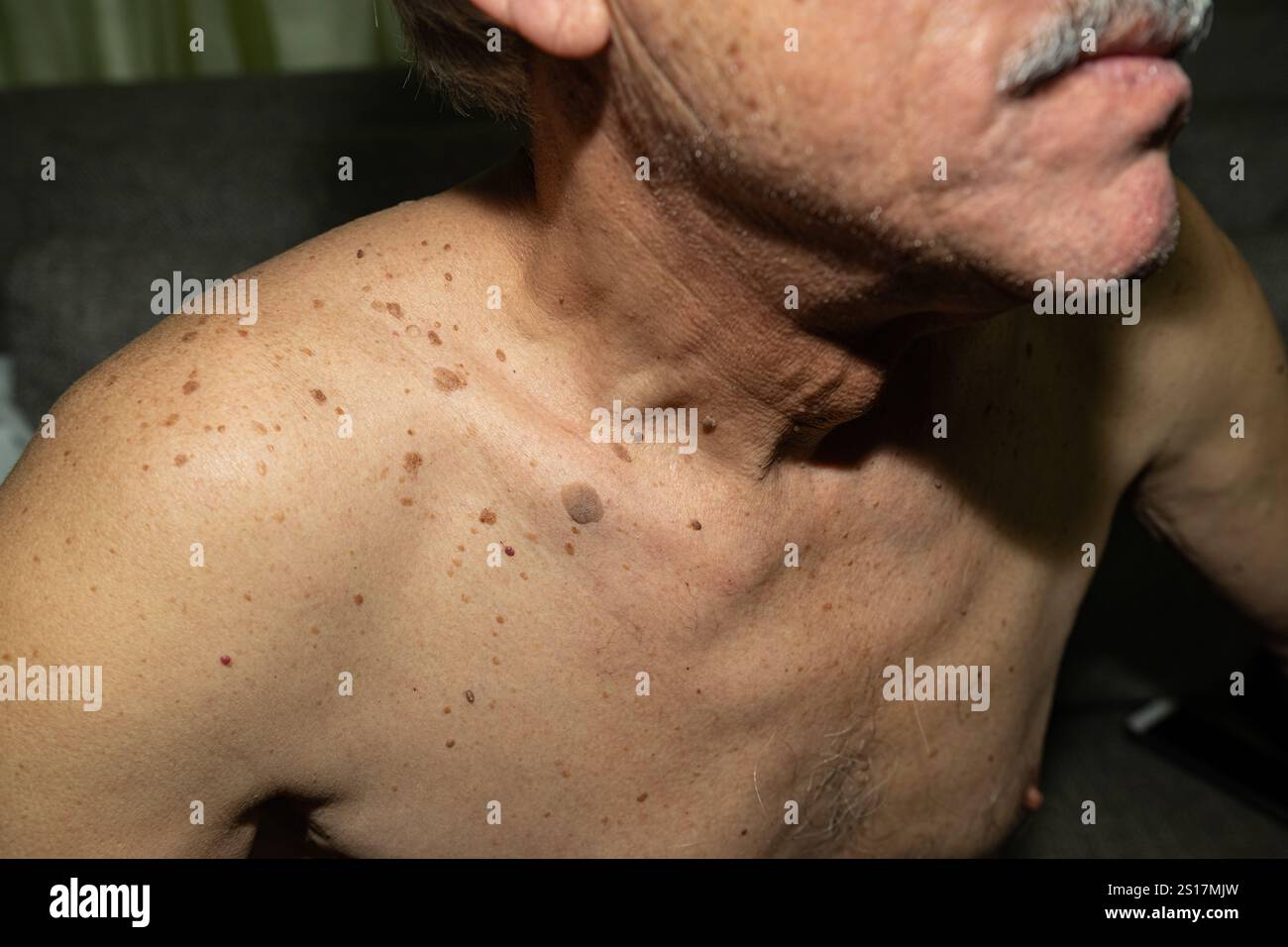 Brown spots, freckles on an old man's body. Skin problems Stock Photo ...