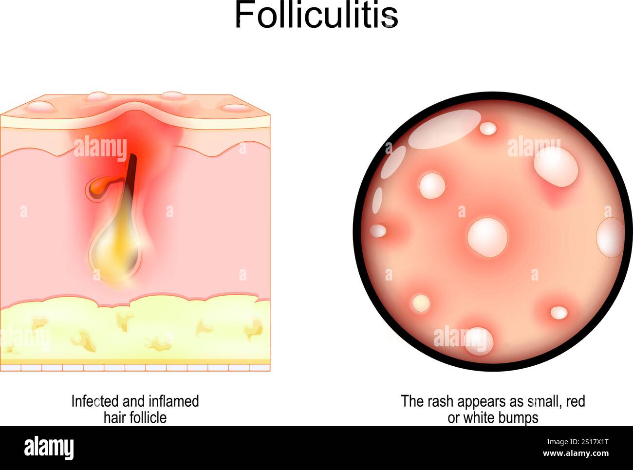 Infected Hair Follicle