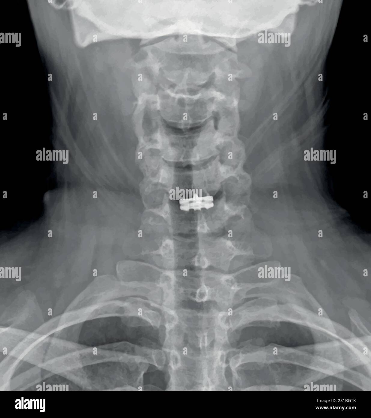 Neck X-ray of a patient undergoing Cervical Microdiscectomy and ...