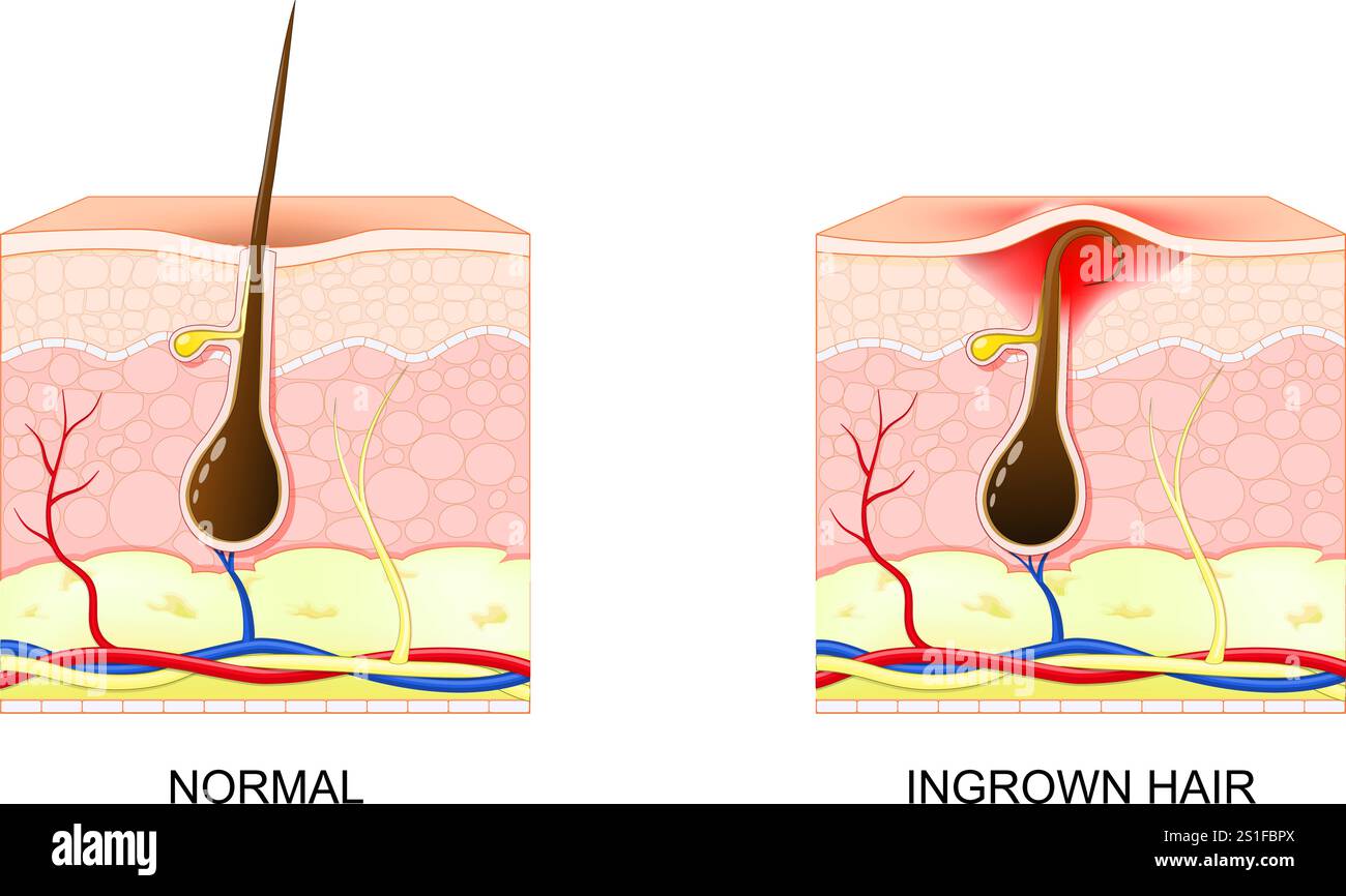 Ingrown hair. Hair follicle entrapment. Shaving irritation. Comparison ... Ingrown hair. Hair follicle entrapment. Shaving irritation. Comparison ...