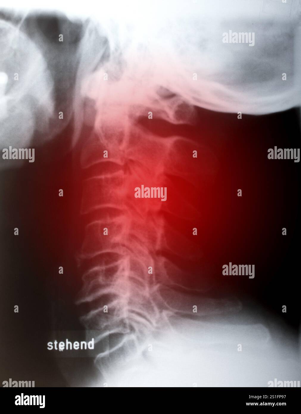 Cervical control hi-res stock photography and images - Alamy