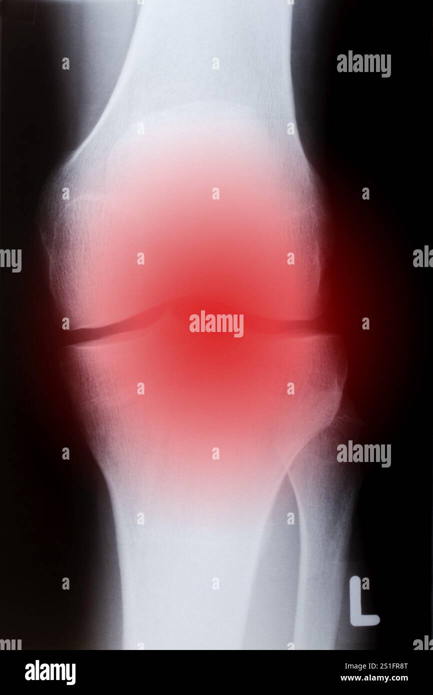 X-ray image of the left knee from the front Stock Photo - Alamy