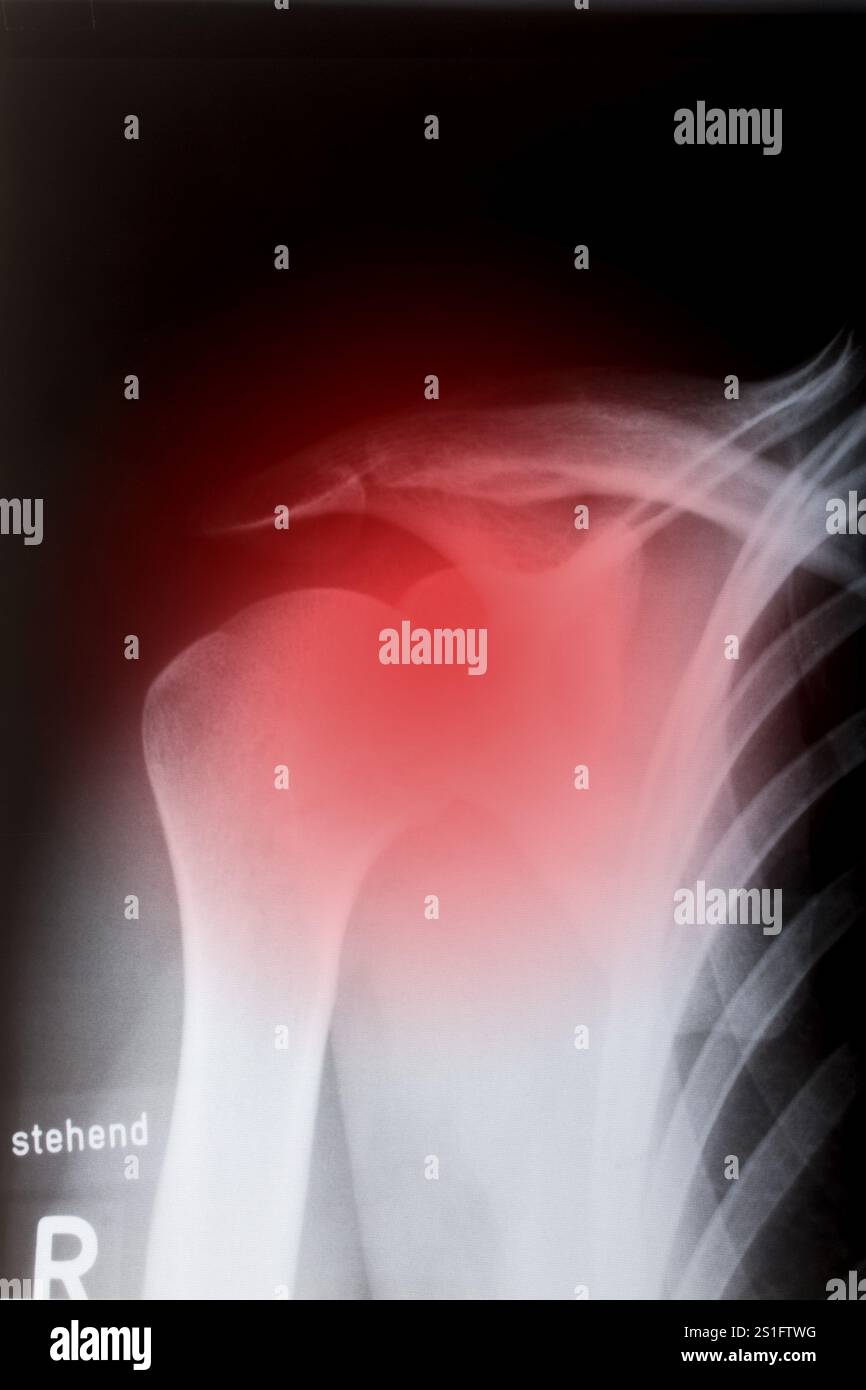 X-ray image of the shoulder joint Stock Photo - Alamy