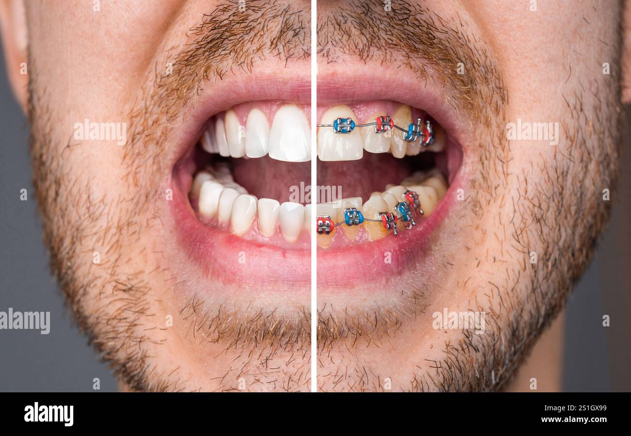 Teeth of male before and after dental braces treatment. Health care and ...