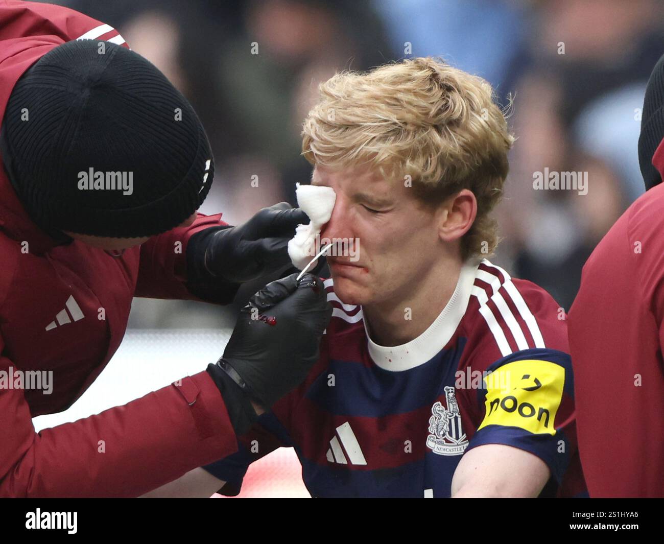 London, UK. 04th Jan, 2025. Anthony Gordon (NU) with a bloody nose at the Tottenham Hotspur v ...