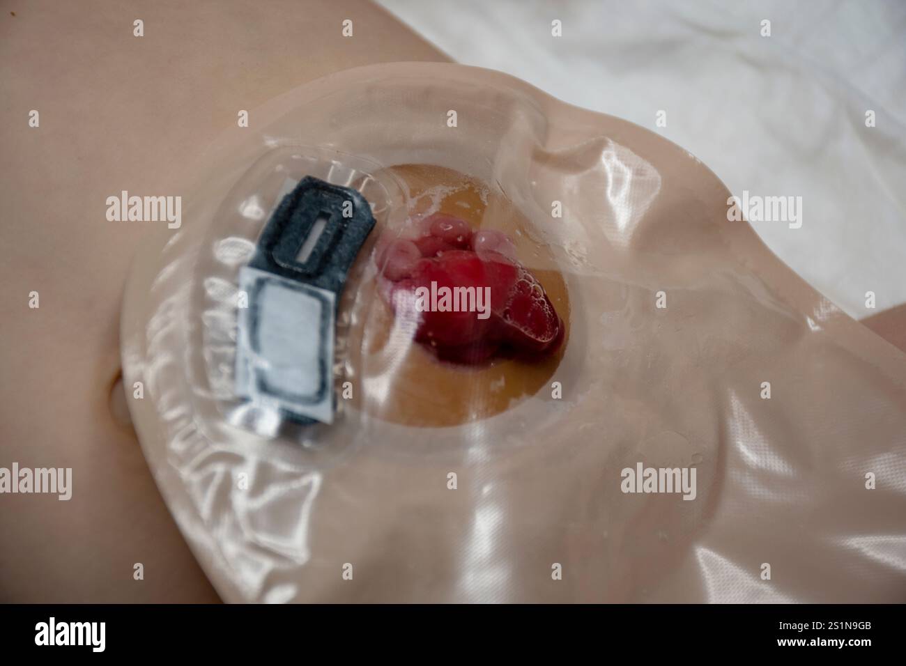 Close-up top view on transparent colostomy pouch attached to baby ...