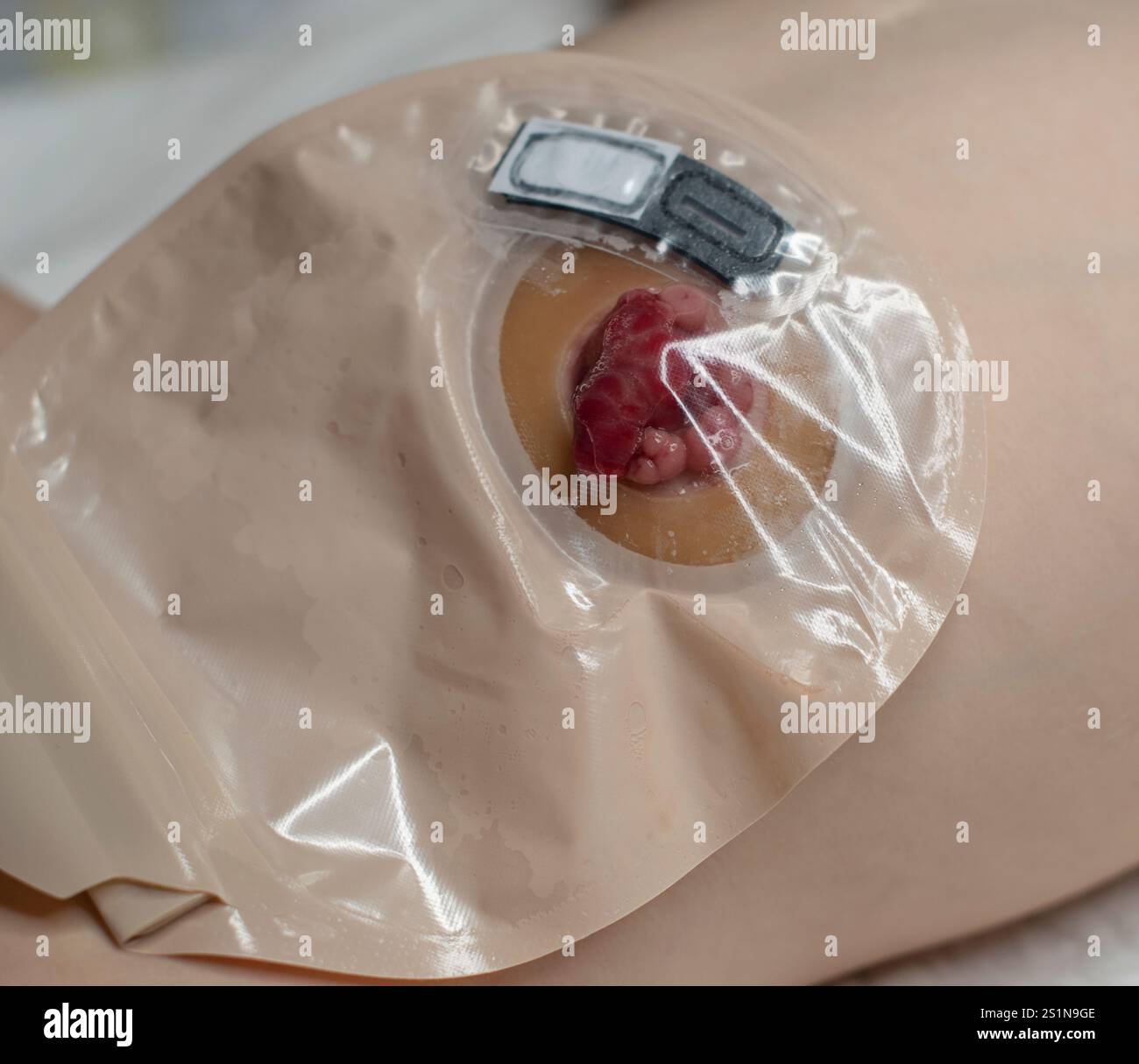 Close-up top view on transparent colostomy pouch attached to baby ...