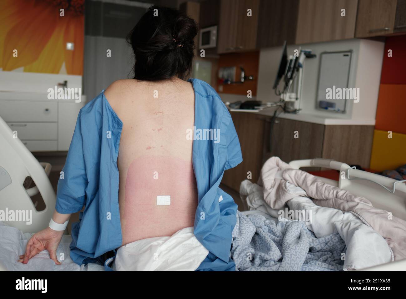 Woman with post epidural injection bandaid on a hospital bed Stock ...