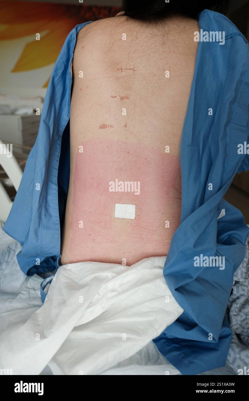 Woman with post epidural injection bandaid on a hospital bed Stock ...