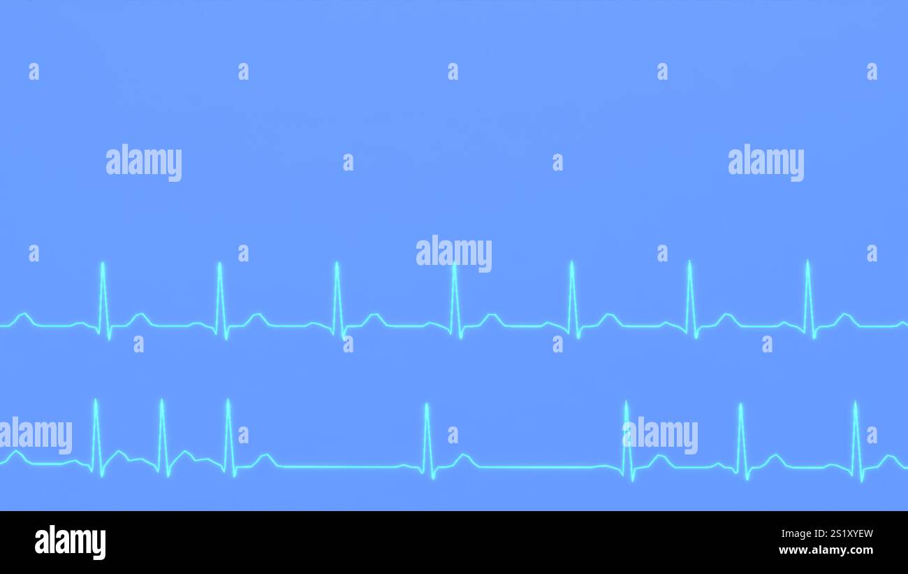 ECG graphs comparison of normal heart rhythm and arrhythmia Stock Photo ...