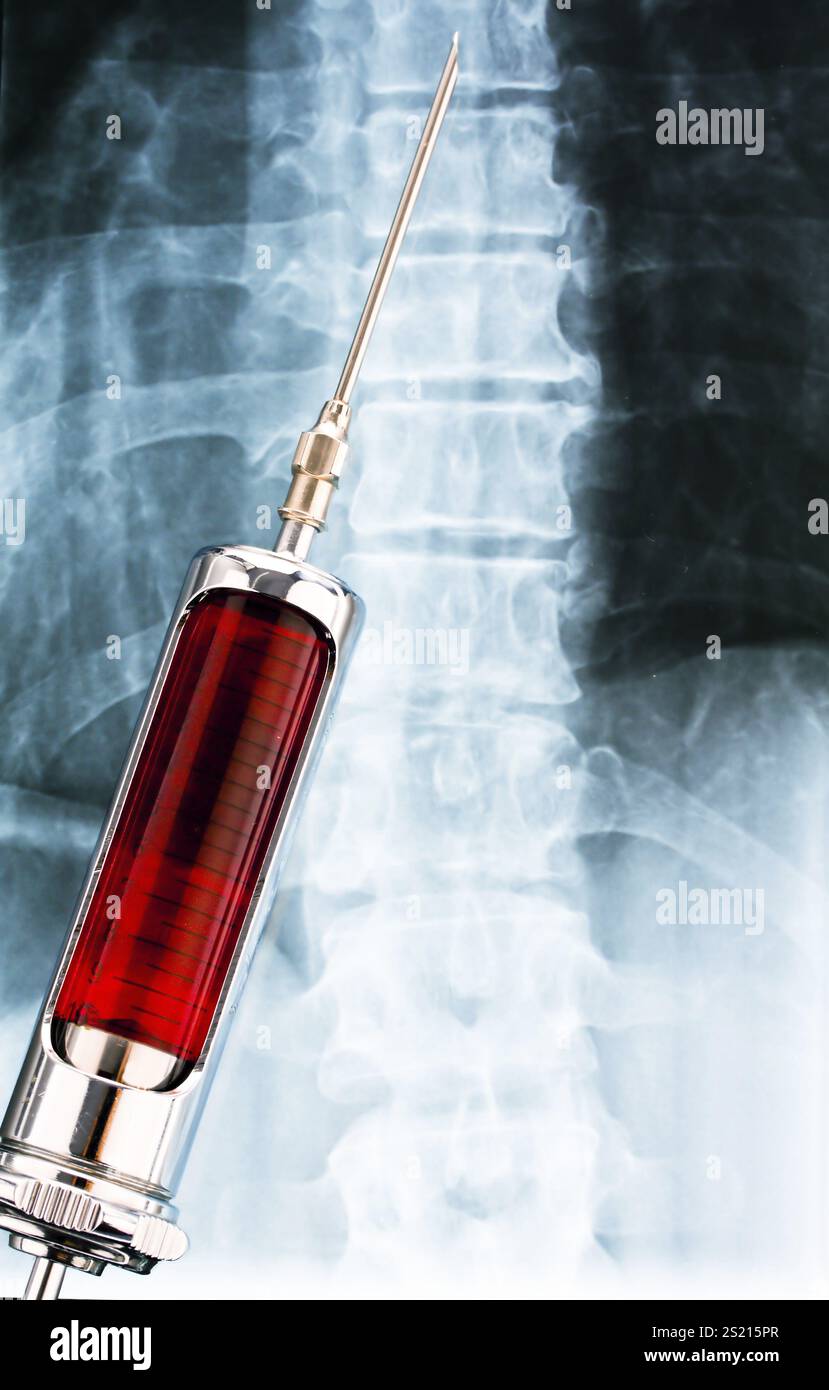 Injection needle and syringe in front of an X-ray image Austria Stock ...