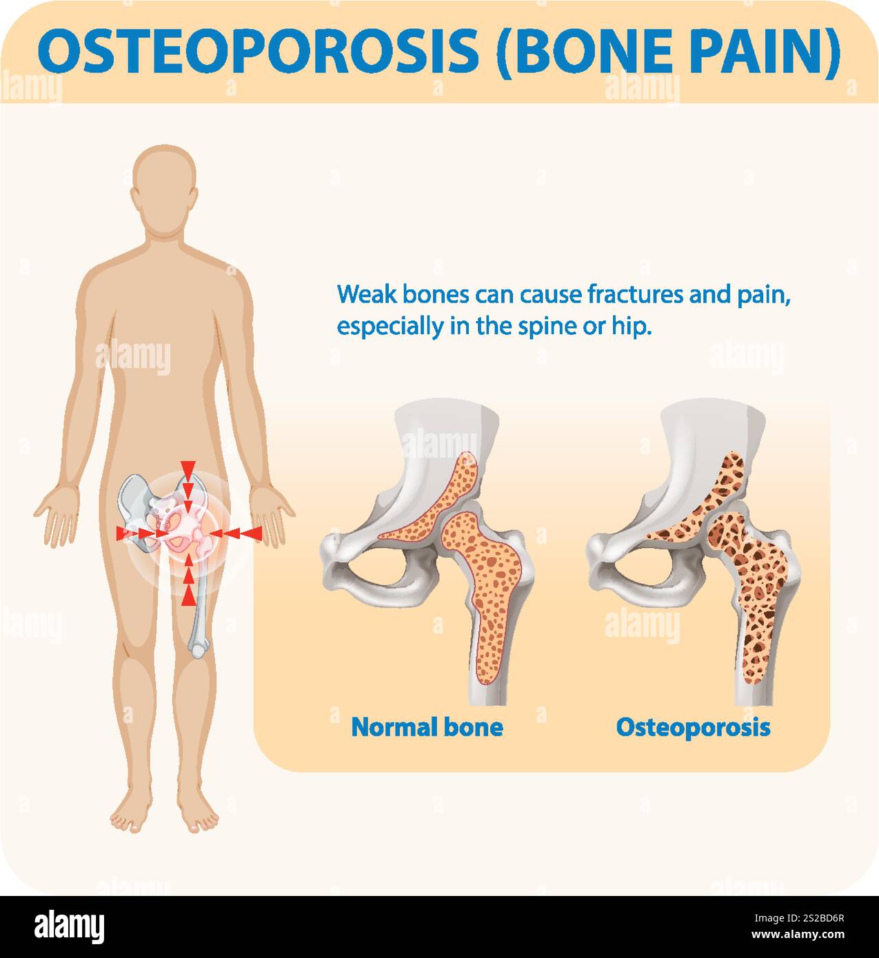 Illustration of bone health and osteoporosis effects Stock Vector Image ...