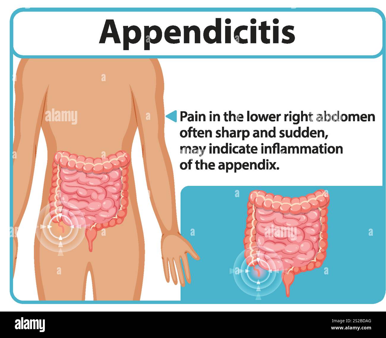 Healthcare appendicitis Cut Out Stock Images & Pictures - Alamy