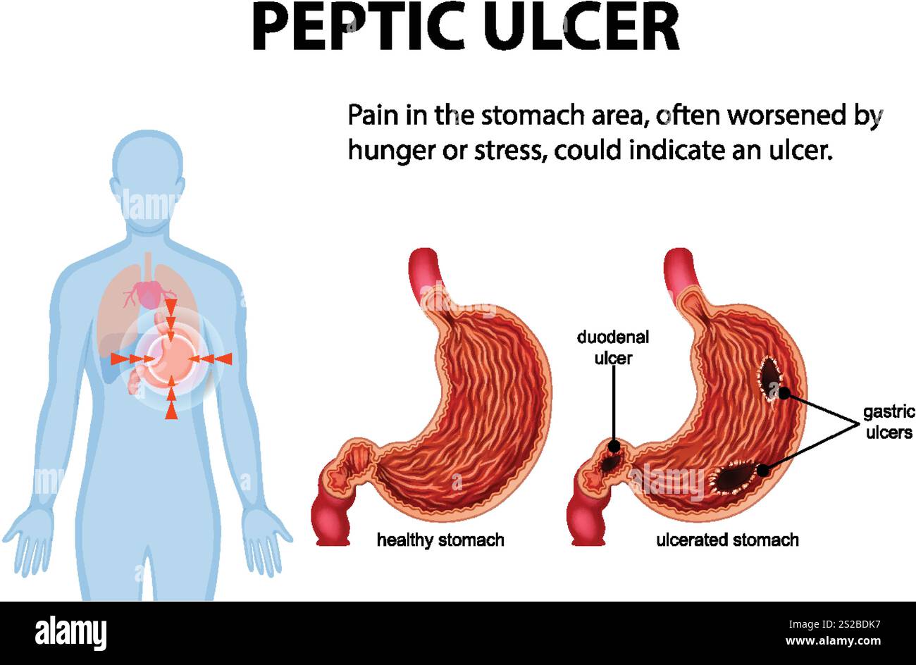 Illustration of stomach ulcers and related symptoms Stock Vector Image ...