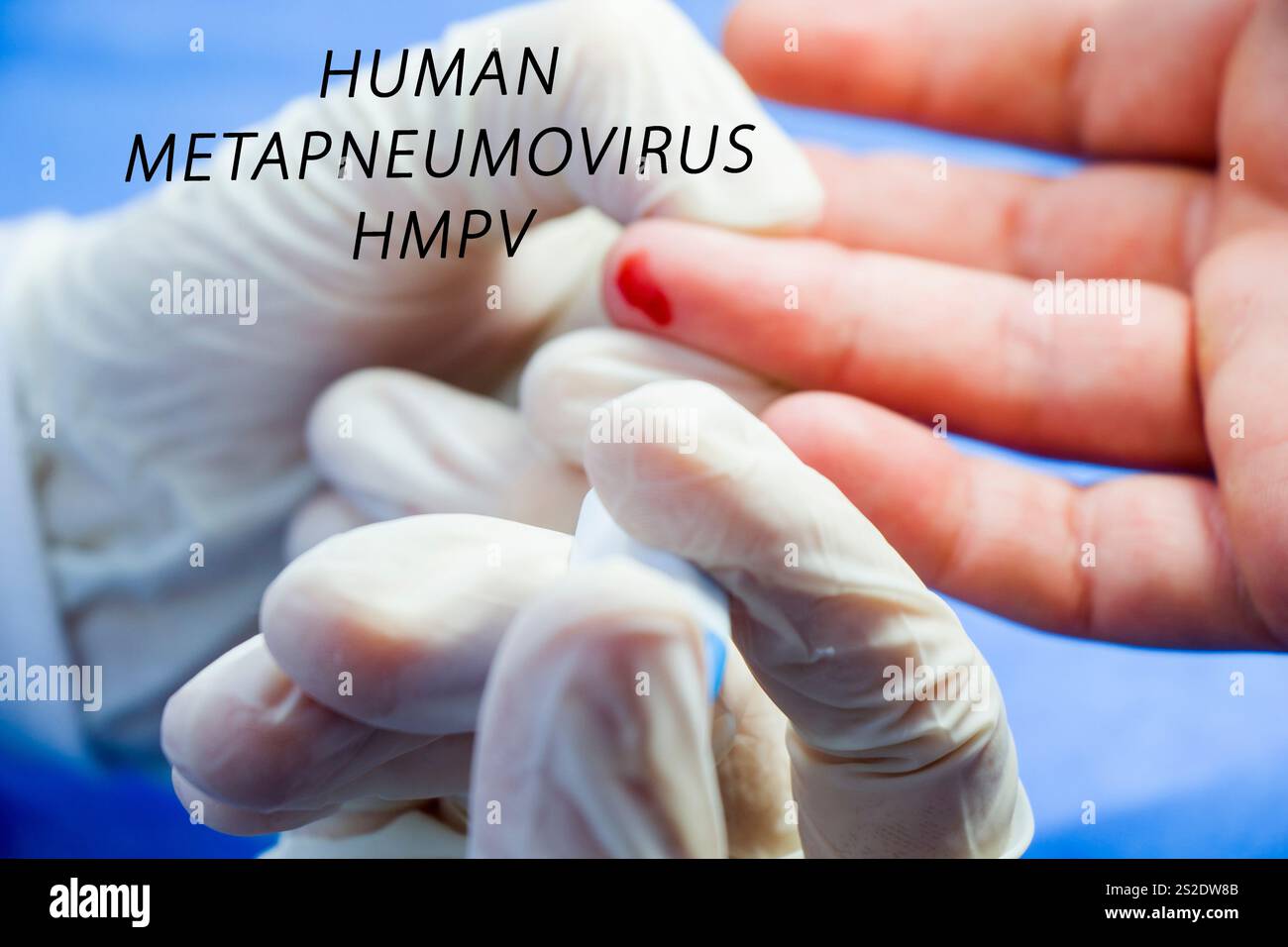Human Metapneumovirus, HMPV virus testing process, blood test and ...