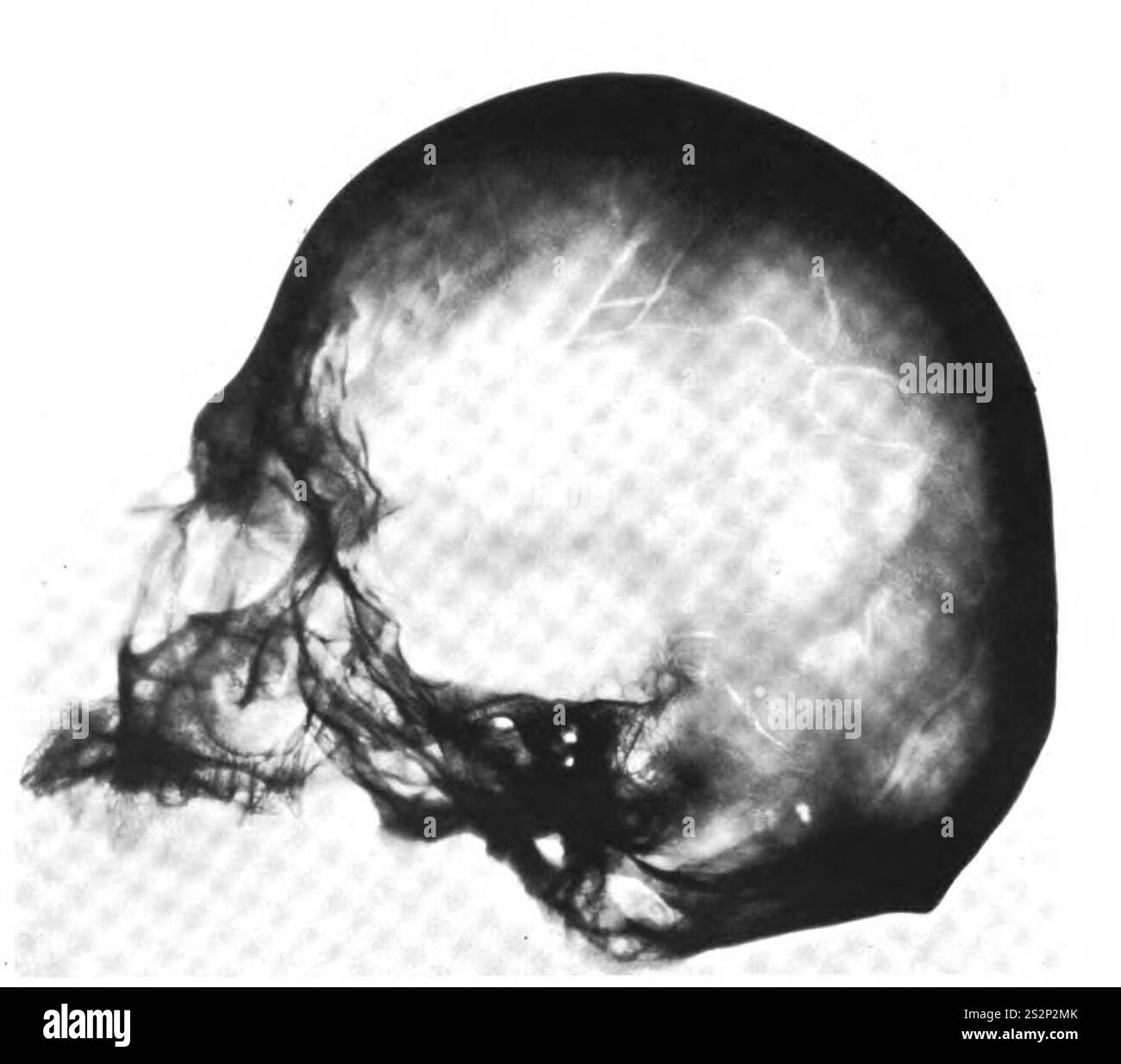 Fletcher Oxycephaly 24 Stock Photo - Alamy