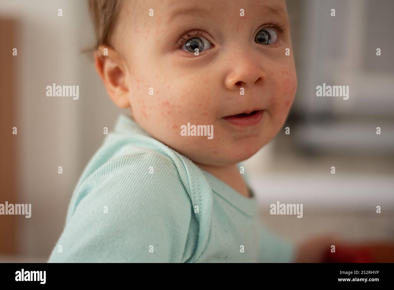 9-month-old baby with skin rash Stock Photo - Alamy