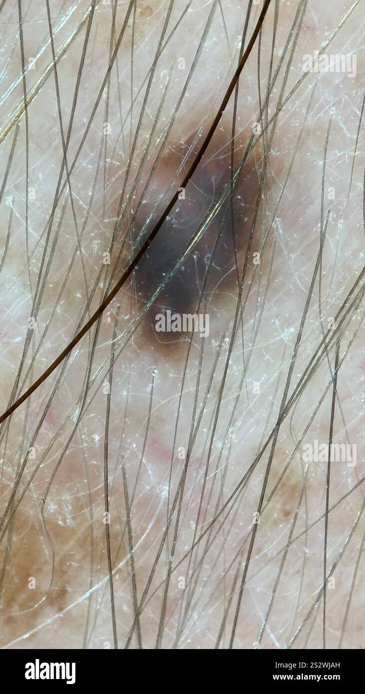 Dermatoscope image of a blue naevus on the skin of a Hispanic female ...