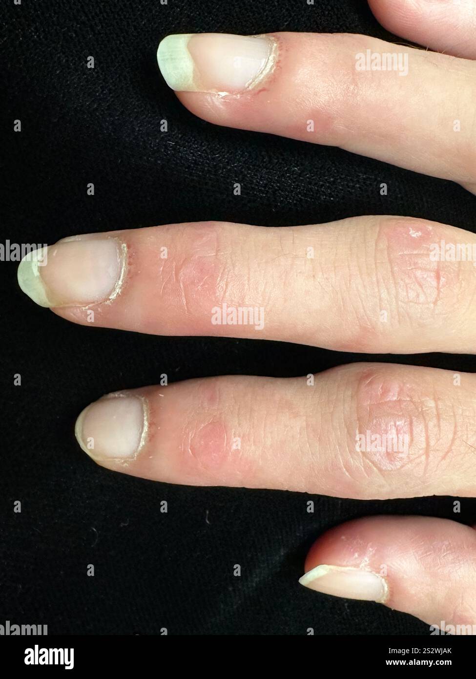 Inflamed fingers of an 11 year old female Hispanic patient with ...