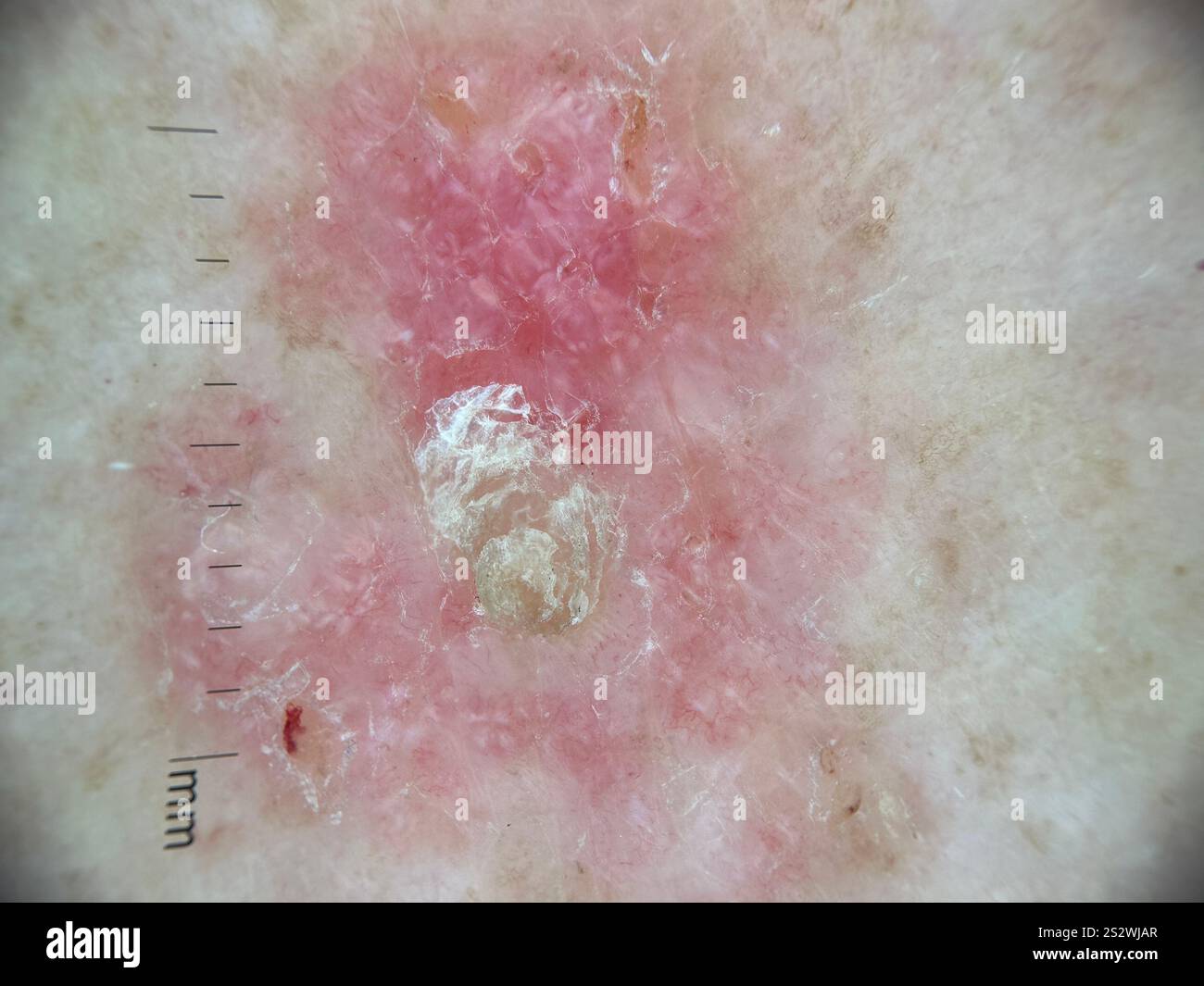 Dermatoscope image of a superficial basal cell carcinoma on the thigh ...