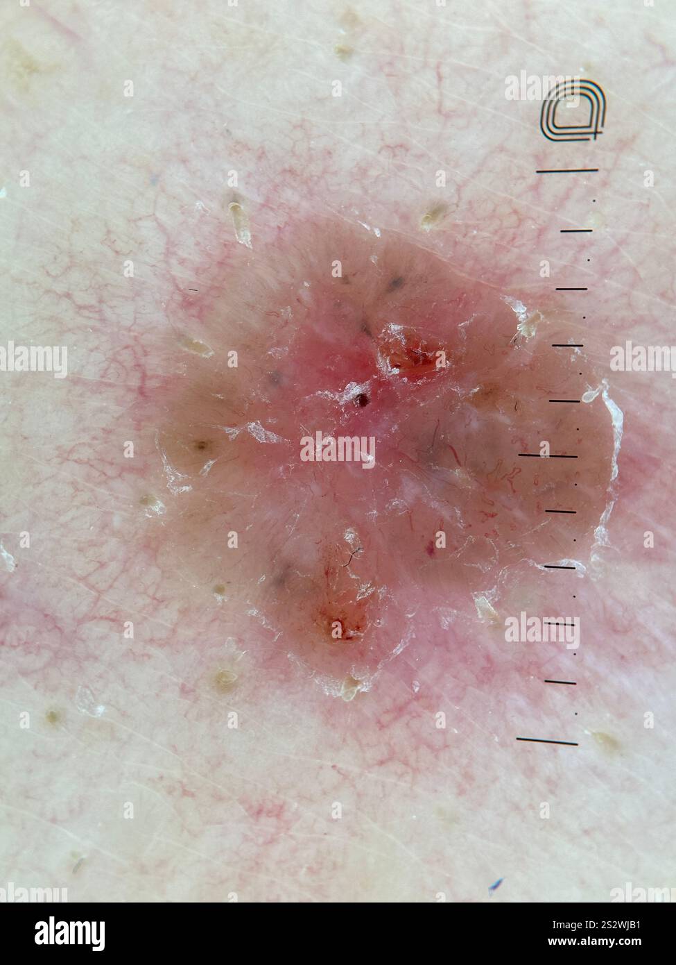 Dermatoscope image of a basal cell carcinoma (BCC), or rodent ulcer, on ...