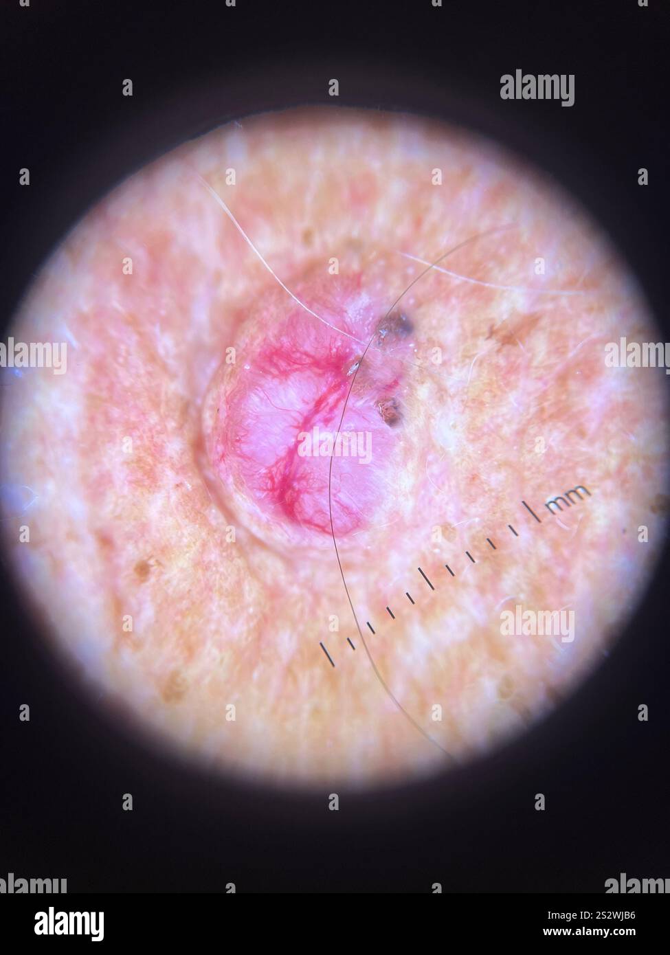 Dermatoscope image of a basal cell carcinoma (BCC), or rodent ulcer, on ...