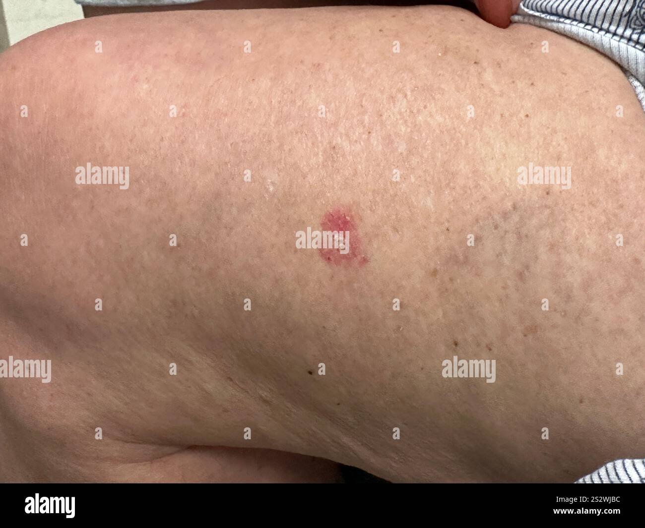 Superficial basal cell carcinoma on the thigh of a 69 year old Hispanic ...