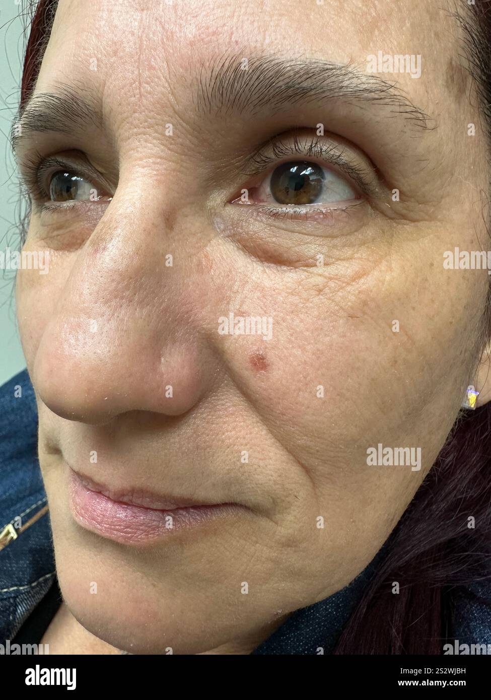 Nodular basal cell carcinoma (BCC), or rodent ulcer, on a Hispanic ...