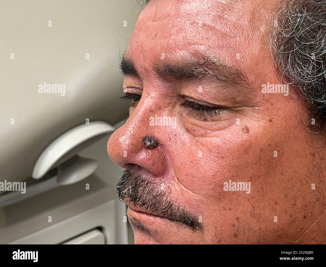 Pigmented basal cell carcinoma (BCC), or rodent ulcer, on a patient's ...