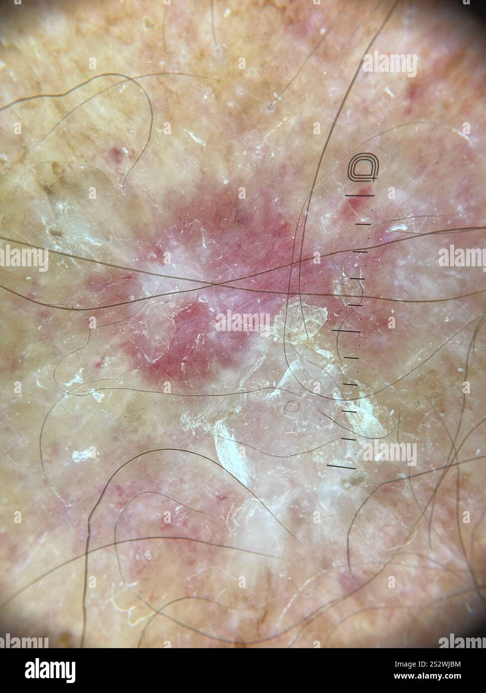 Dermatoscope image of a superficial basal cell carcinoma on the leg of ...